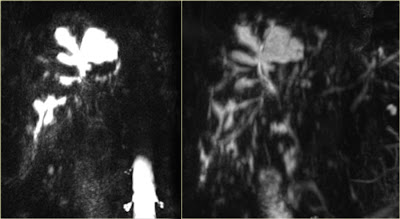 ON - RADIOLOGY: What`s Caroli Disease and Caroli syndrome??