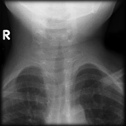 ON - RADIOLOGY: Croup (acute laryngotracheobronchitis) on X-ray with ...
