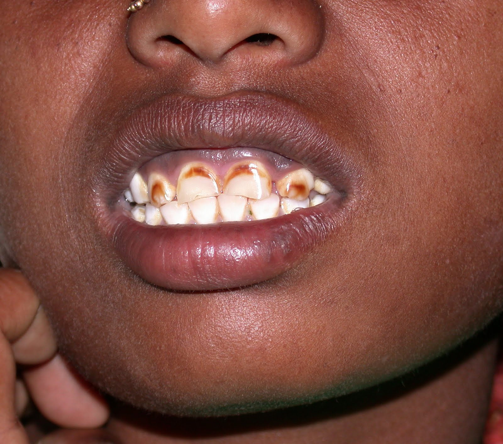 Doctors Gates Fluorosis Dental Staining Doctors Gates Fluorosis Dental Staining