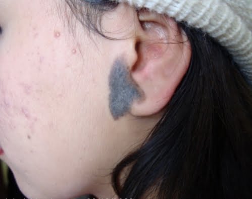 Doctors Gates: Linear epidermal nevus