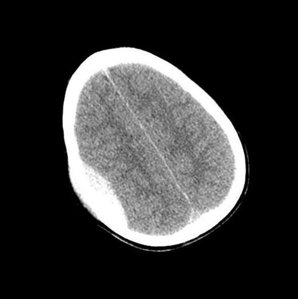 Doctors Gates: Epidural hematoma in CT
