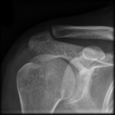ON - RADIOLOGY: Allman and Tossy classification for Acromioclavicular ...