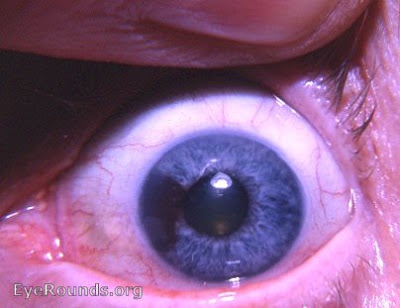 Doctors Gates: differential diagnosis of a heavily pigmented iris lesion