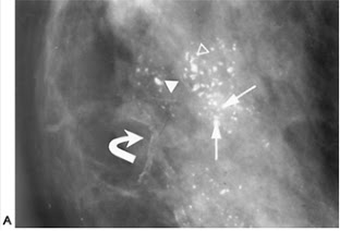 ON - RADIOLOGY: CALCIFICATIONS in Carcinoma of the breast