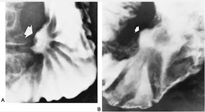 ON - RADIOLOGY: Peptic ulcer disease