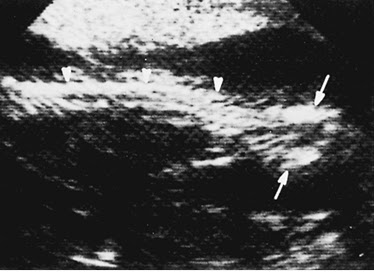 ON - RADIOLOGY: Anencephaly as a 1st congenital anomaly in fetal sonography