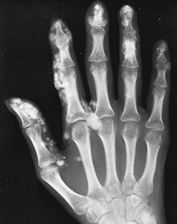 ON - RADIOLOGY: Calcification changes in Dermatomyositis