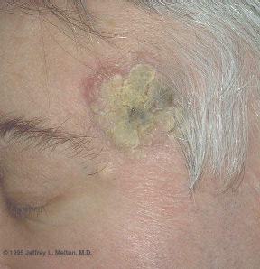 Doctors Gates: Basosquamous Carcinoma in the Temple