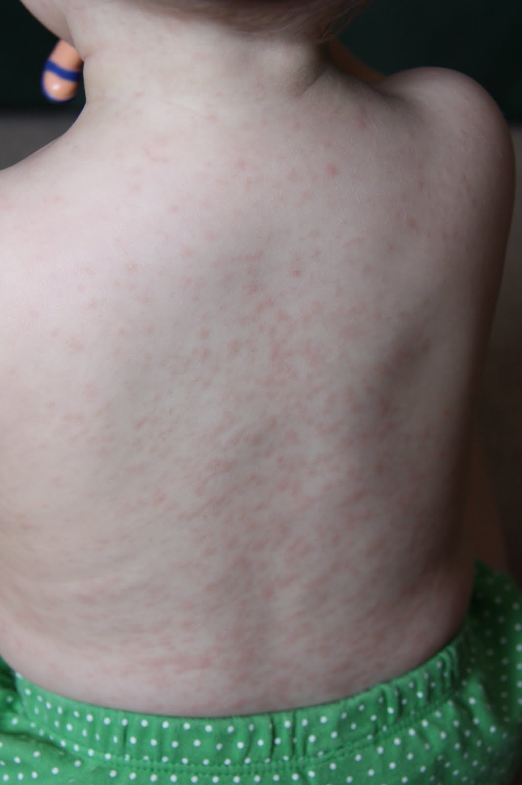 Polka Dot Rash All Over Body at Jenny Abate blog