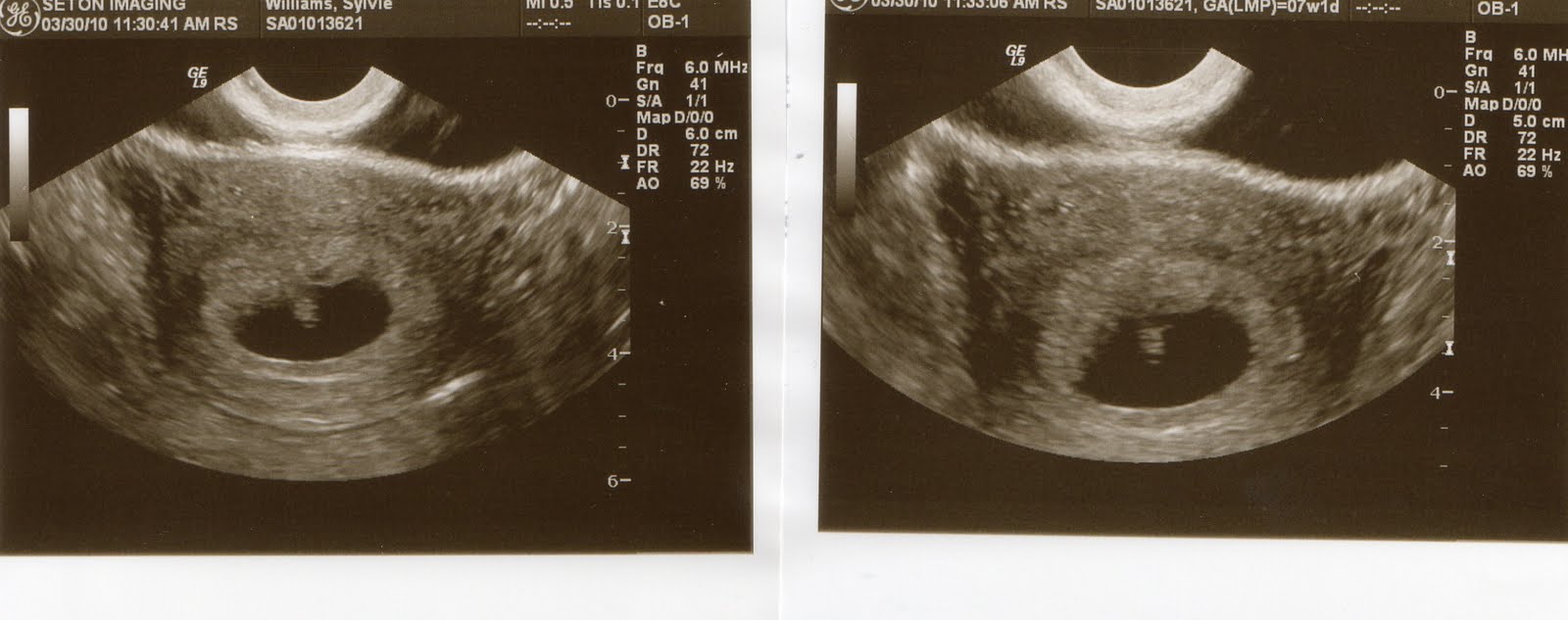 Project Williams Baby: First ultrasound!
