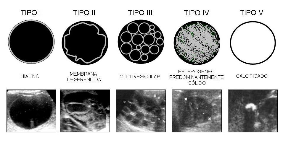 Hidatidosis: Esquema de Clasificación de Gharbi
