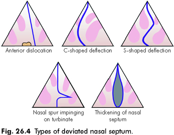 MEDICAL MNEMONICS: Types of DNS (Deviated Nasal Septum)