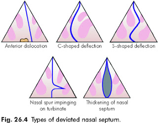 MEDICAL MNEMONICS: Types of DNS (Deviated Nasal Septum)