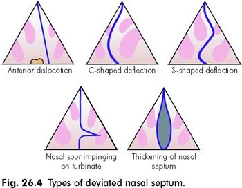MEDICAL MNEMONICS: Types of DNS (Deviated Nasal Septum)
