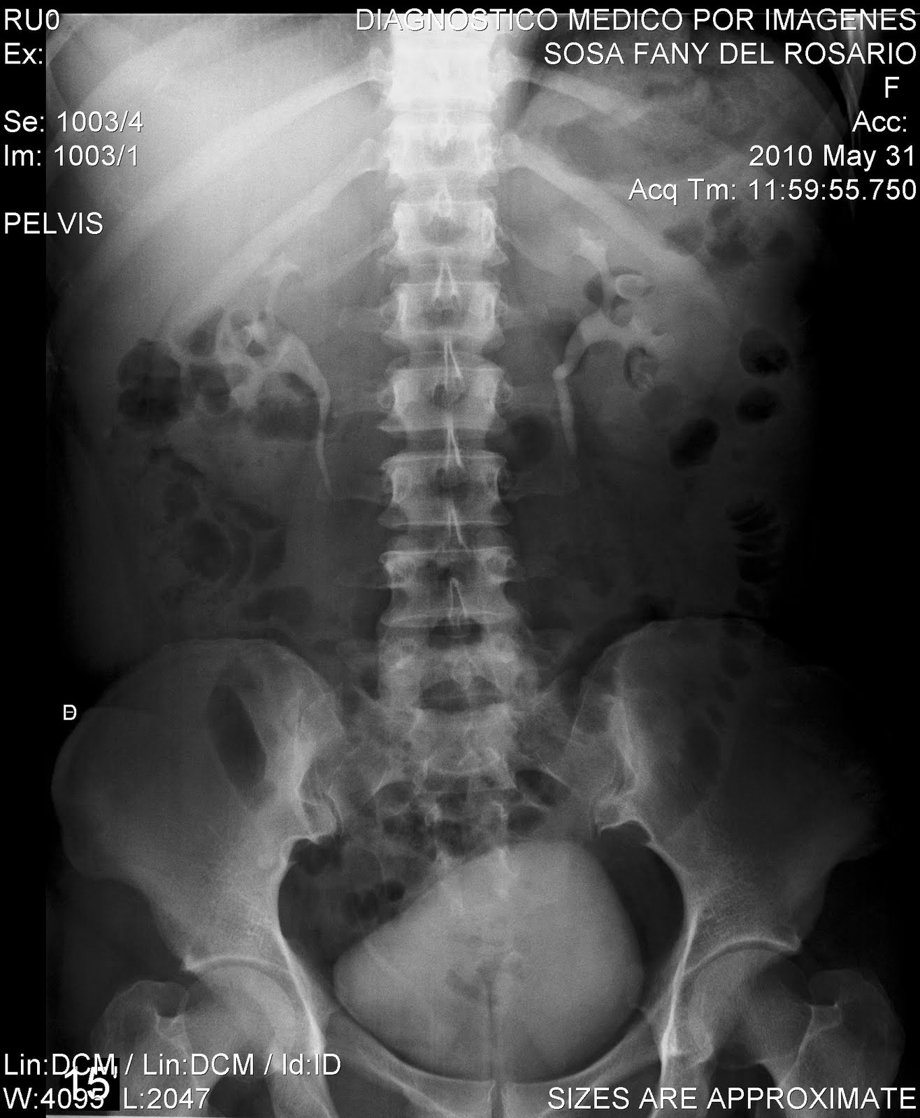 Diagnostico por Imagen: UROGRAMA ESCRETOR, UROGRAFIA ENDOVENOSA O ...