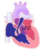 Heart Disease: Tetralogy of Fallot / TOF