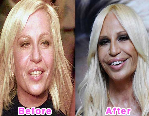Weird: 16 Worst Celebrity Plastic Surgery Disaster