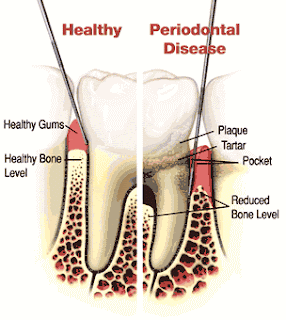 Periodoncia: Periodontitis