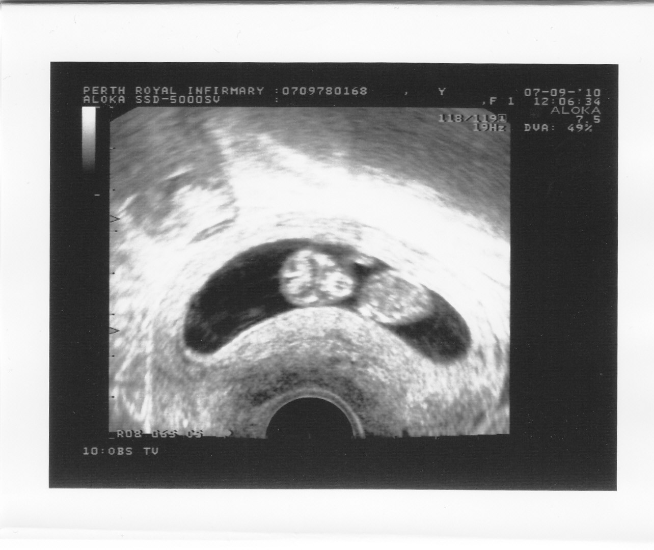 Our Wee Baby: babys first scan 10 weeks 5 days