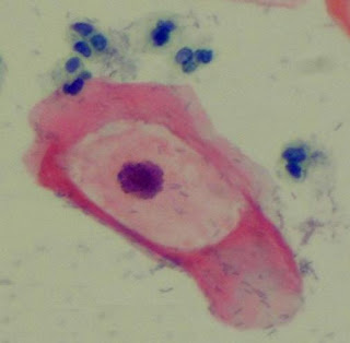 Virus del papiloma humano (VPH): Virus del Papiloma Humano