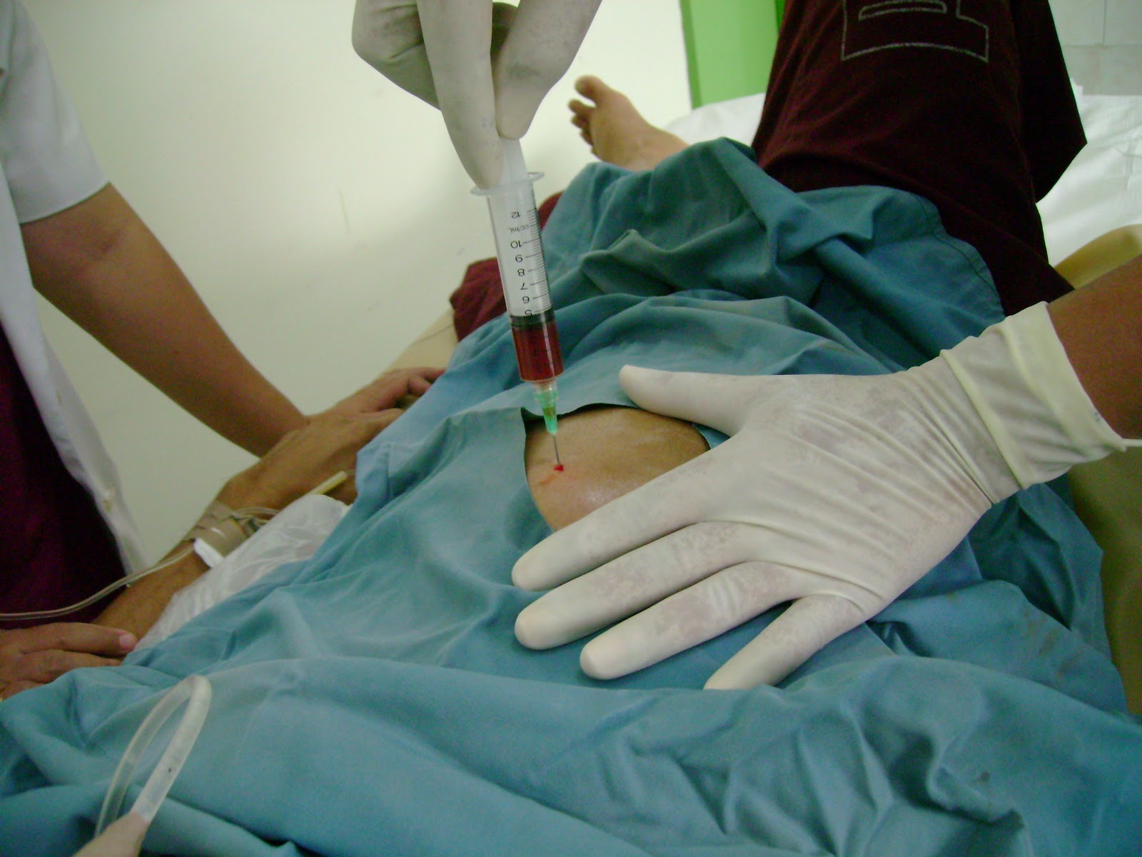 my-GASTROENTEROHEPATOLOGY: Percutaneous catheter drainage in critical ...