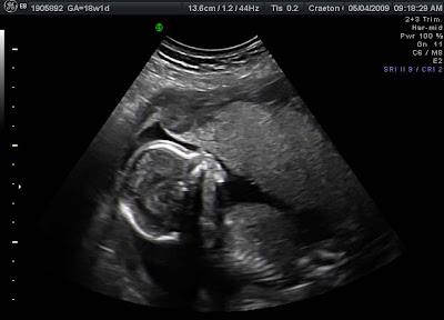 Livin' la Vida Roko: Ultrasound - 18 weeks