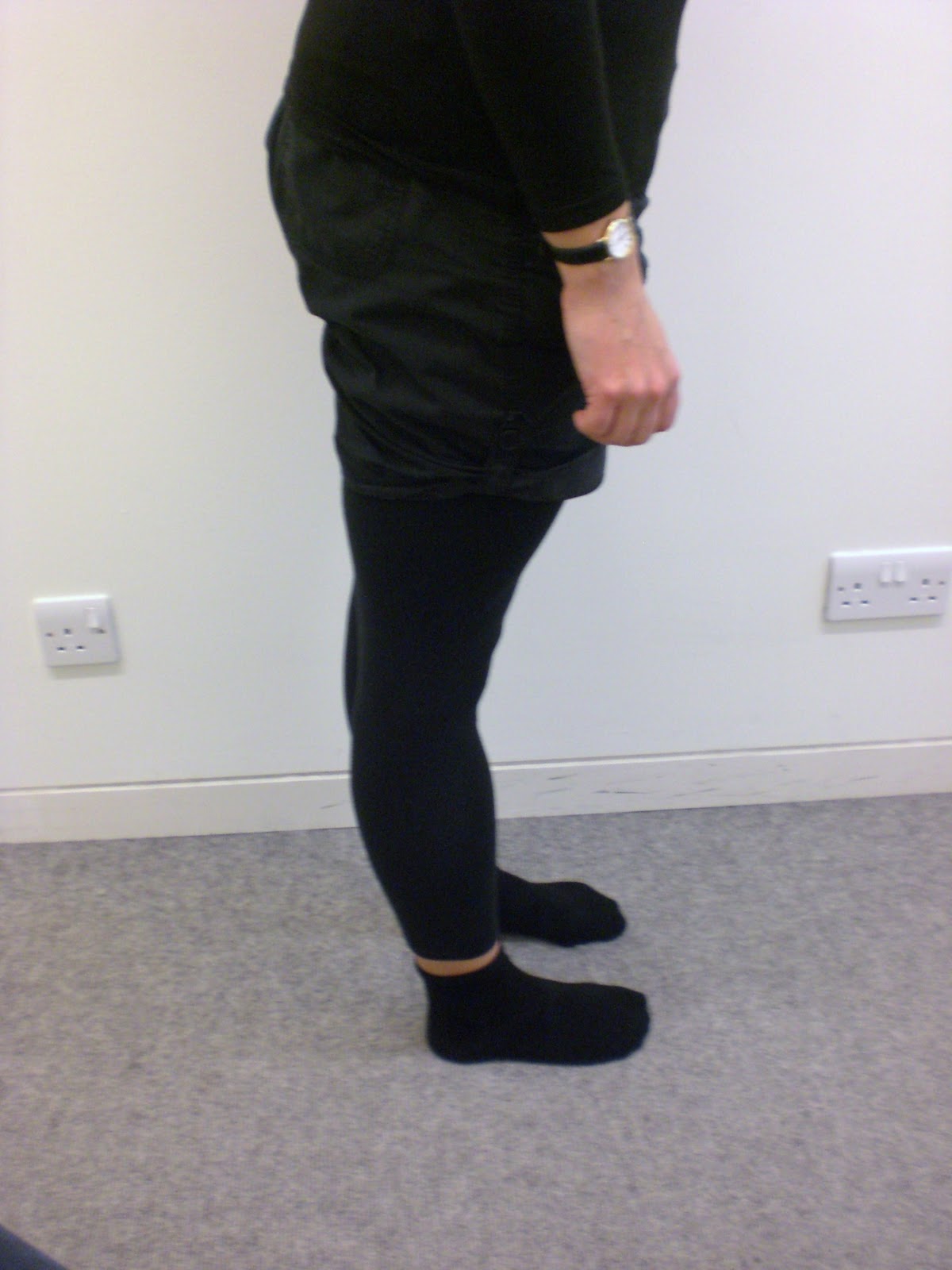 Dance Injury and Ehlers-Danlos Type III Hypermobility Syndrome ...