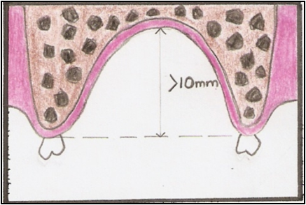 Tania's Dental Projects: A New Classification of Palatal vaults: A ...