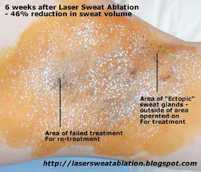 bromhidrosis - meddic