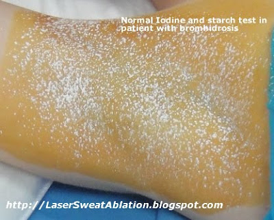 bromhidrosis - meddic