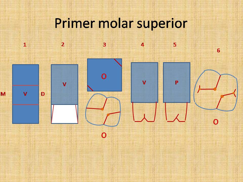 Odontogye: Tallado del primer molar superior