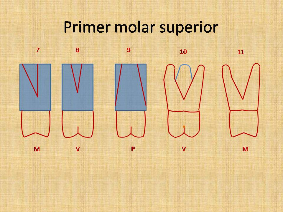 Odontogye: Tallado del primer molar superior