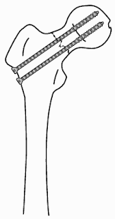 Orthopaedics Mcqs Postgraduation entrance preparation: 90 - Pins ...