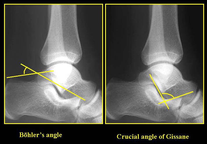MEDICAL IMAGES: Critical angle of Gissane
