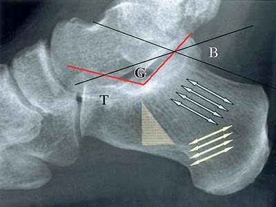 Orthopaedics Mcqs Postgraduation entrance preparation: 102 - Critical ...