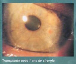 Jonathan Oliveira: Transplante de Córnea