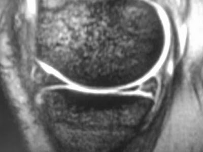 Daily Dose: Vertical tear of the meniscus