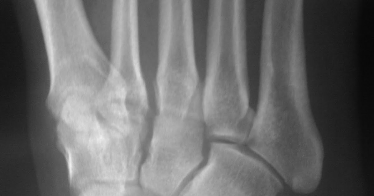 Daily Dose: Fracture base of 2nd metatarsal