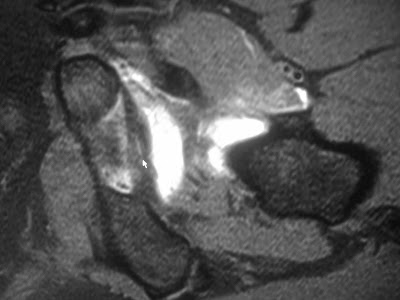 Daily Dose: Transverse acetabular ligament