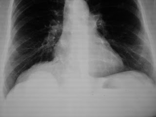 Daily Dose: Focal eventration of diaphragm