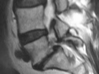 Daily Dose: Pars defect (spondylolysis)