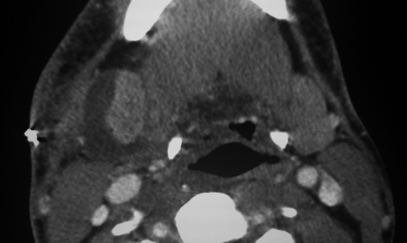 Daily Dose: Submandibular abscess