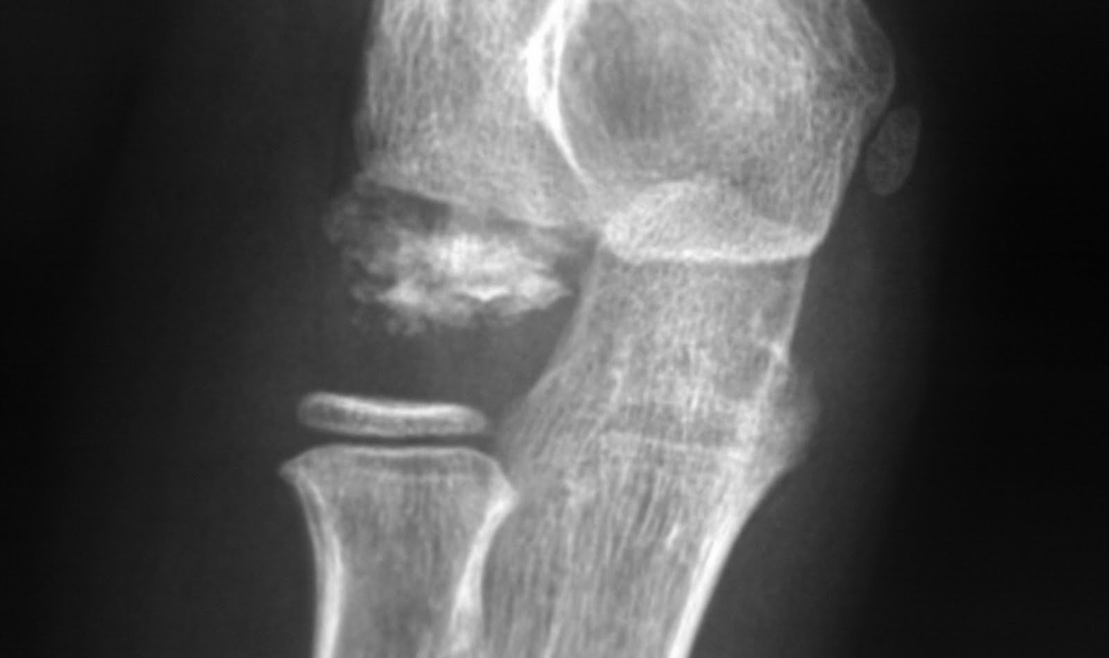 Daily Dose: osteochondritis dessicans of capitellum