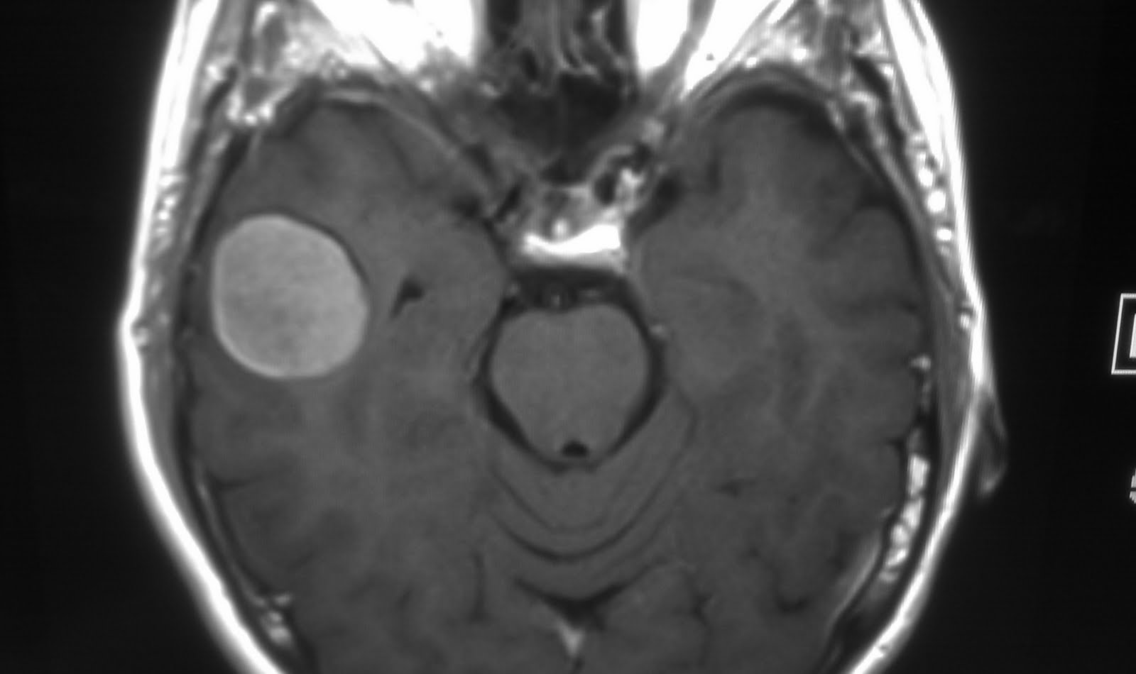 Daily Dose: Meningioma