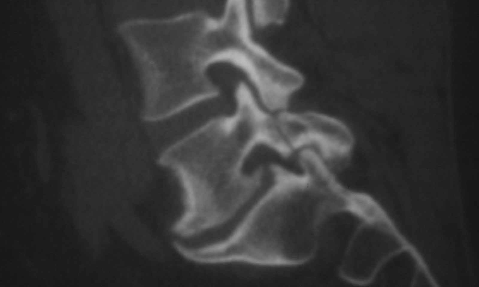 Daily Dose: Unilateral pars defect