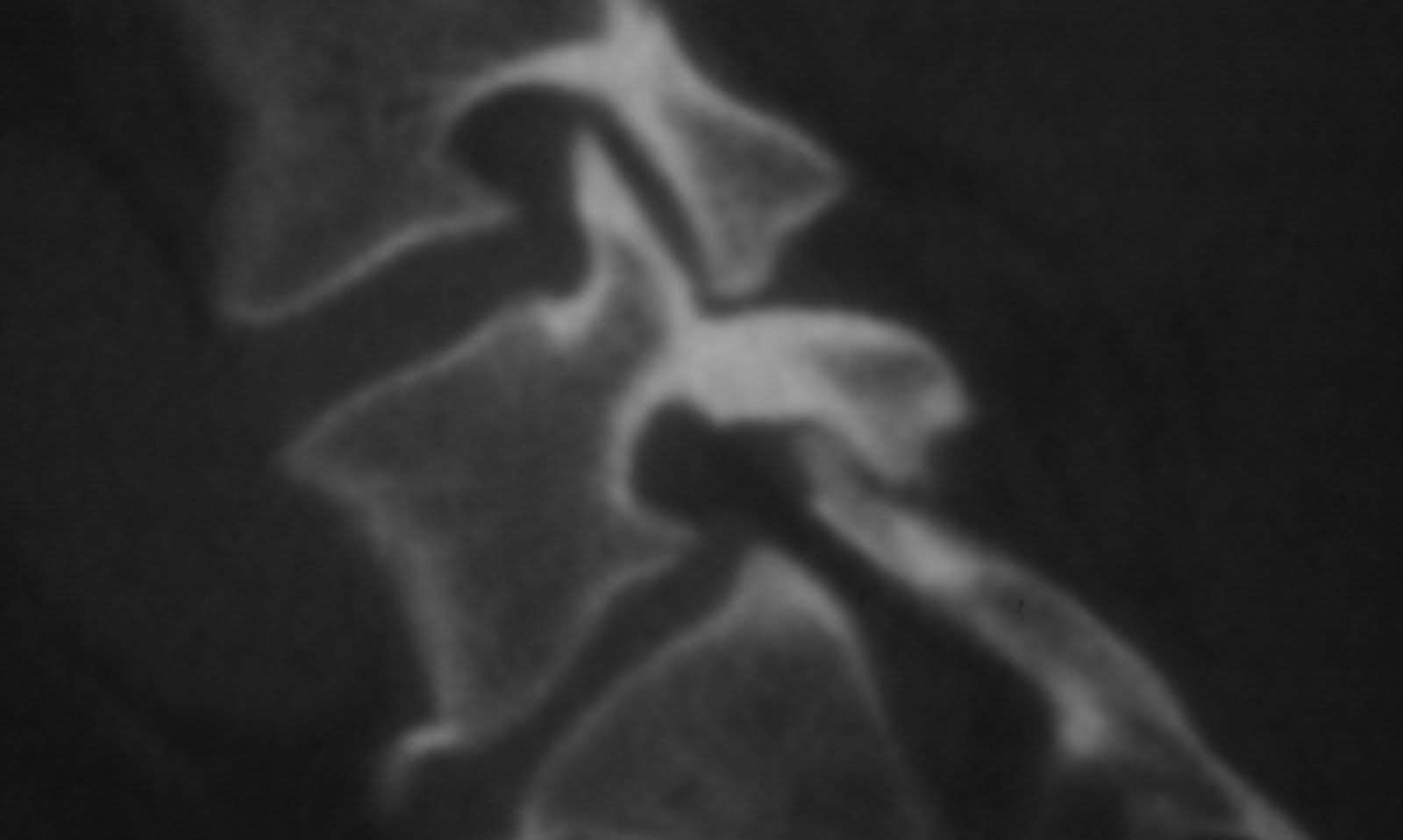 Daily Dose: Unilateral pars defect