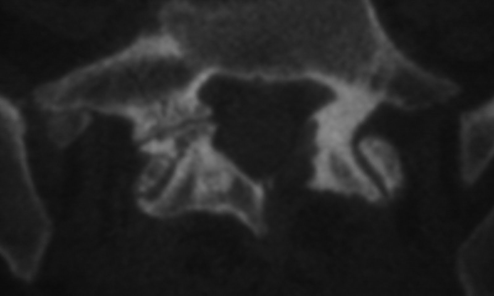 Daily Dose: Unilateral pars defect