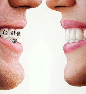 Colores de ligas de frenillos - Imagui