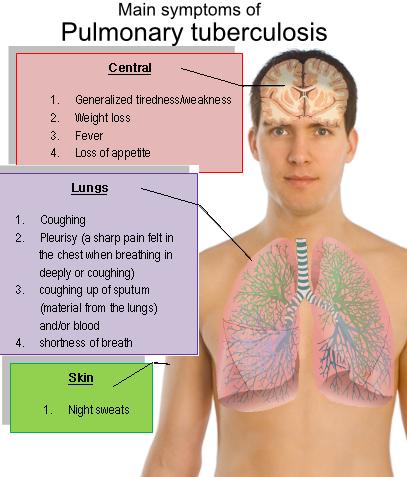 Tuberculosis: Symptoms and diagnosis of tuberculosis