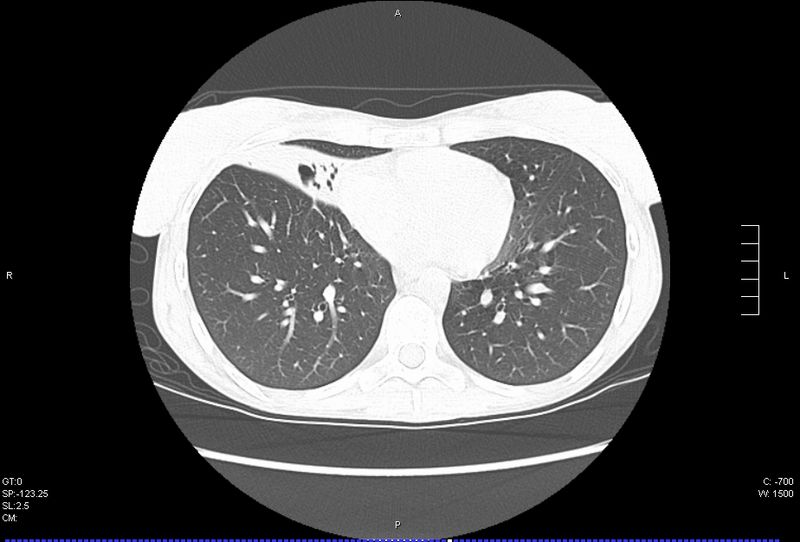 Right Middle Lobe Syndrome | Medicalchemy Respiratory Medicine